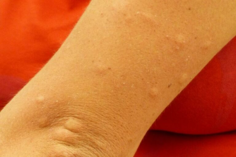 Eerste hulp bij insectenbeten